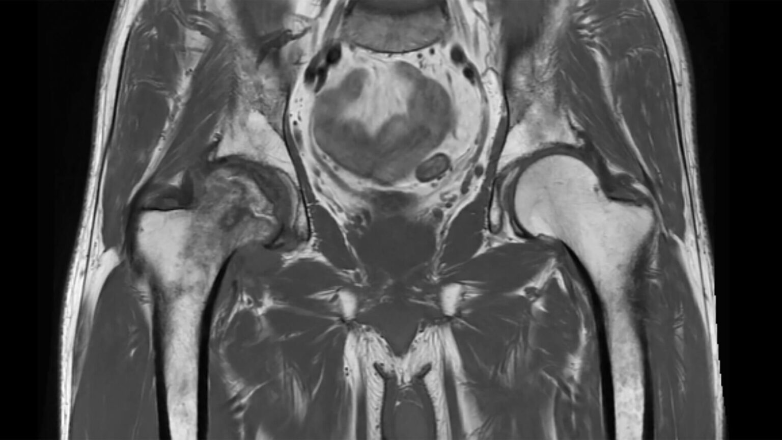 What is Necrosis? - Northeast Knee & Joint Institute